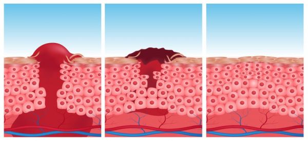 Cicatrisation cutanée normale — PlaieXpertise - Base de connaissances