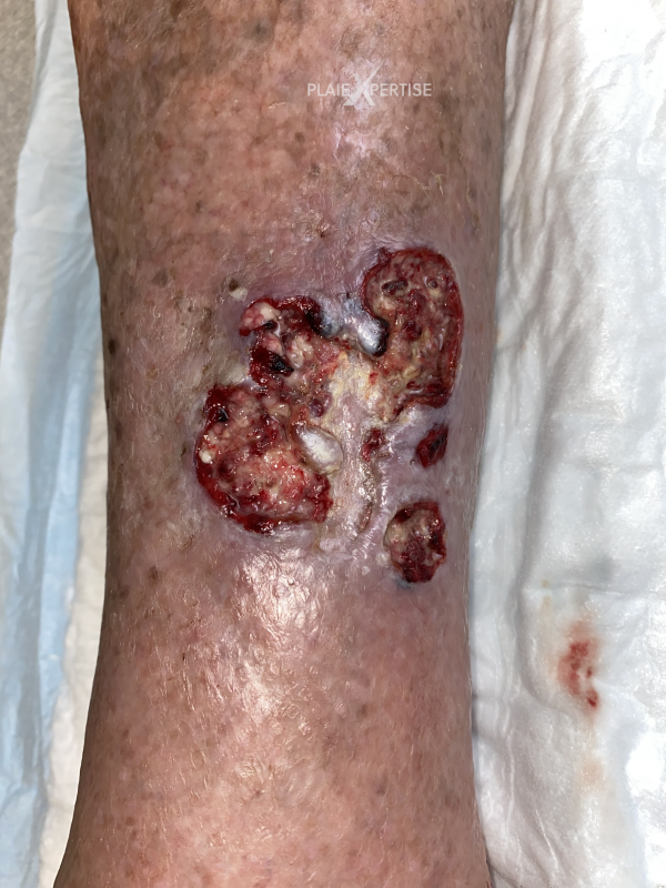 Pyoderma gangrenosum — PlaieXpertise - Base de connaissances