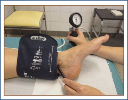 Indice de Pression Systolique (IPS) — PlaieXpertise - Base de connaissances