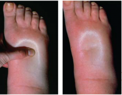 Oedème des membres inférieurs - Aspect clinique — PlaieXpertise - Base ...