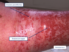 Dermatose Erosive et Pustuleuse de Jambe — PlaieXpertise - Base de ...